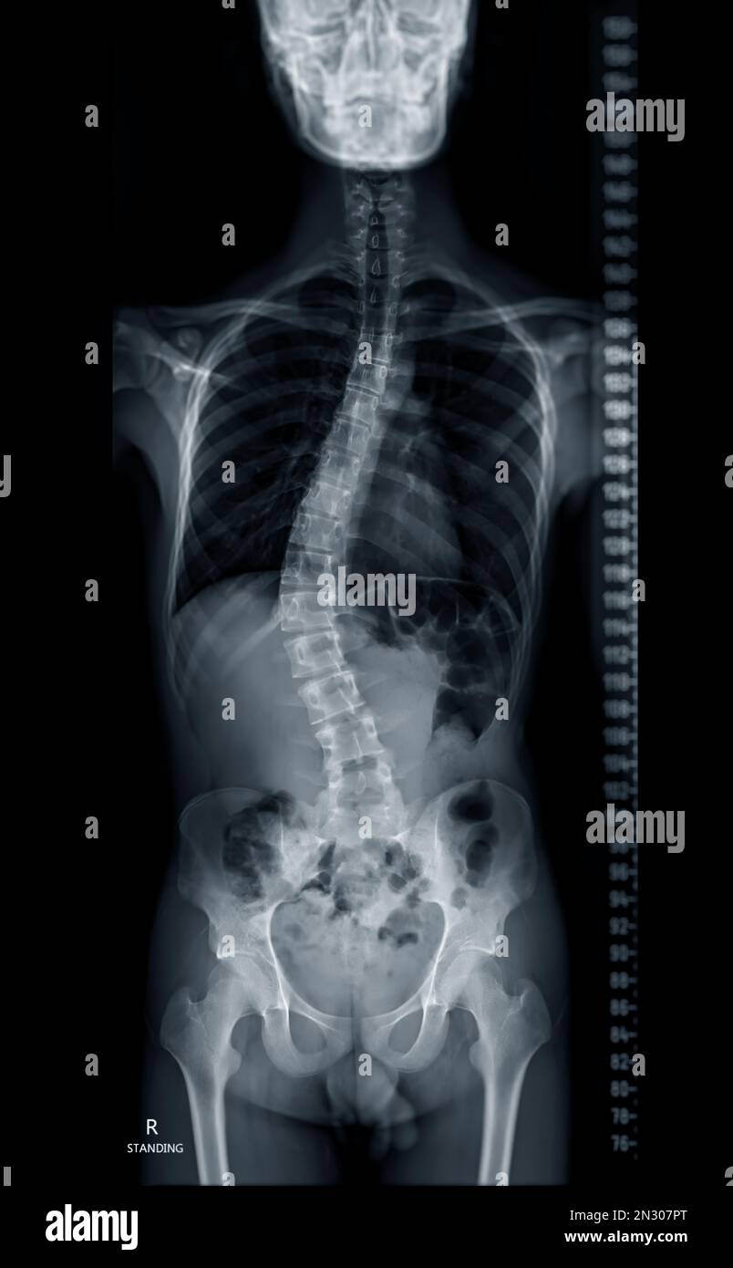X-ray image of Whole Spine for diagnosis scoliosis of spine Stock Photo ...