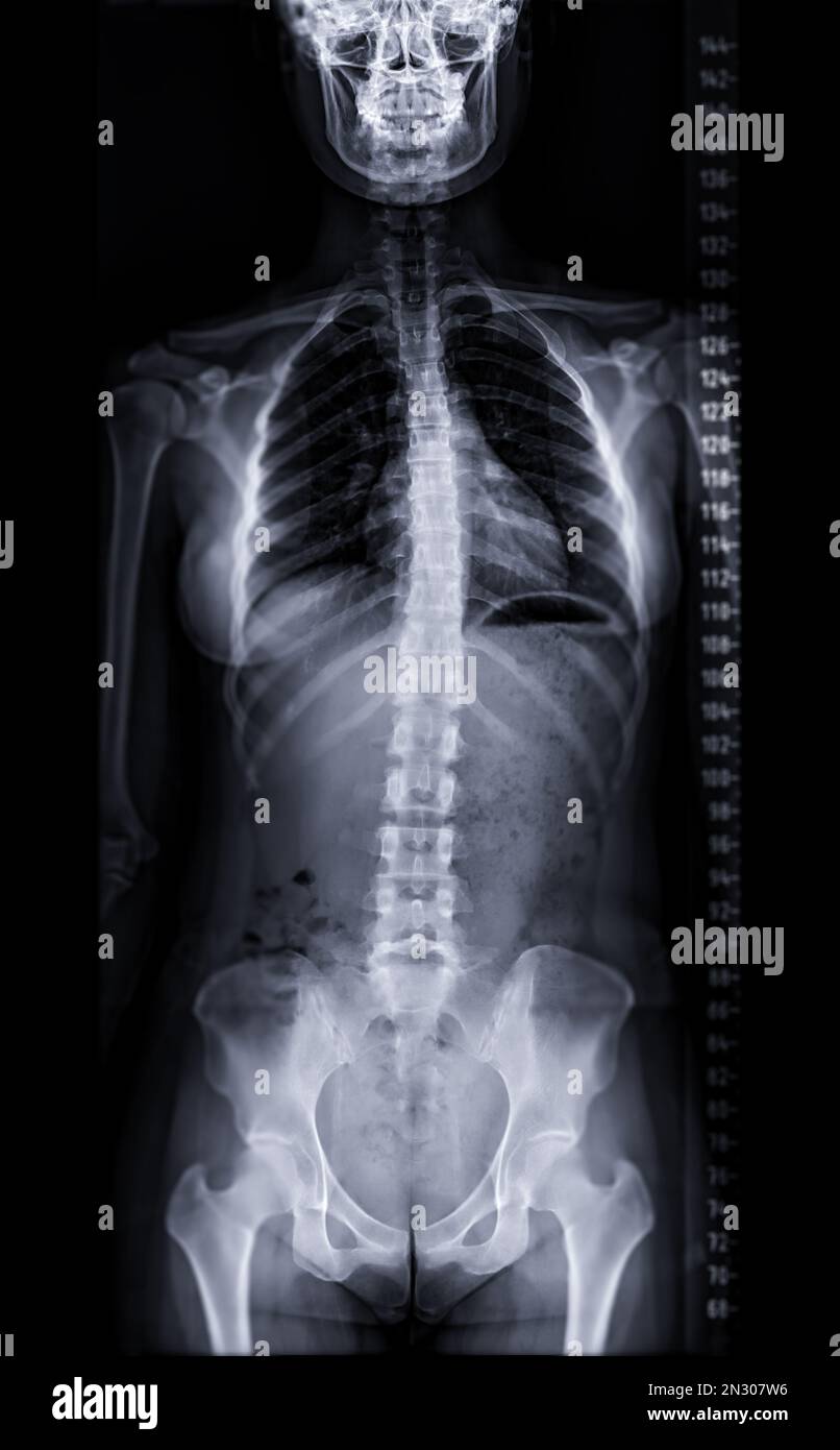 X-ray image of Whole Spine for diagnosis scoliosis of spine Stock Photo ...