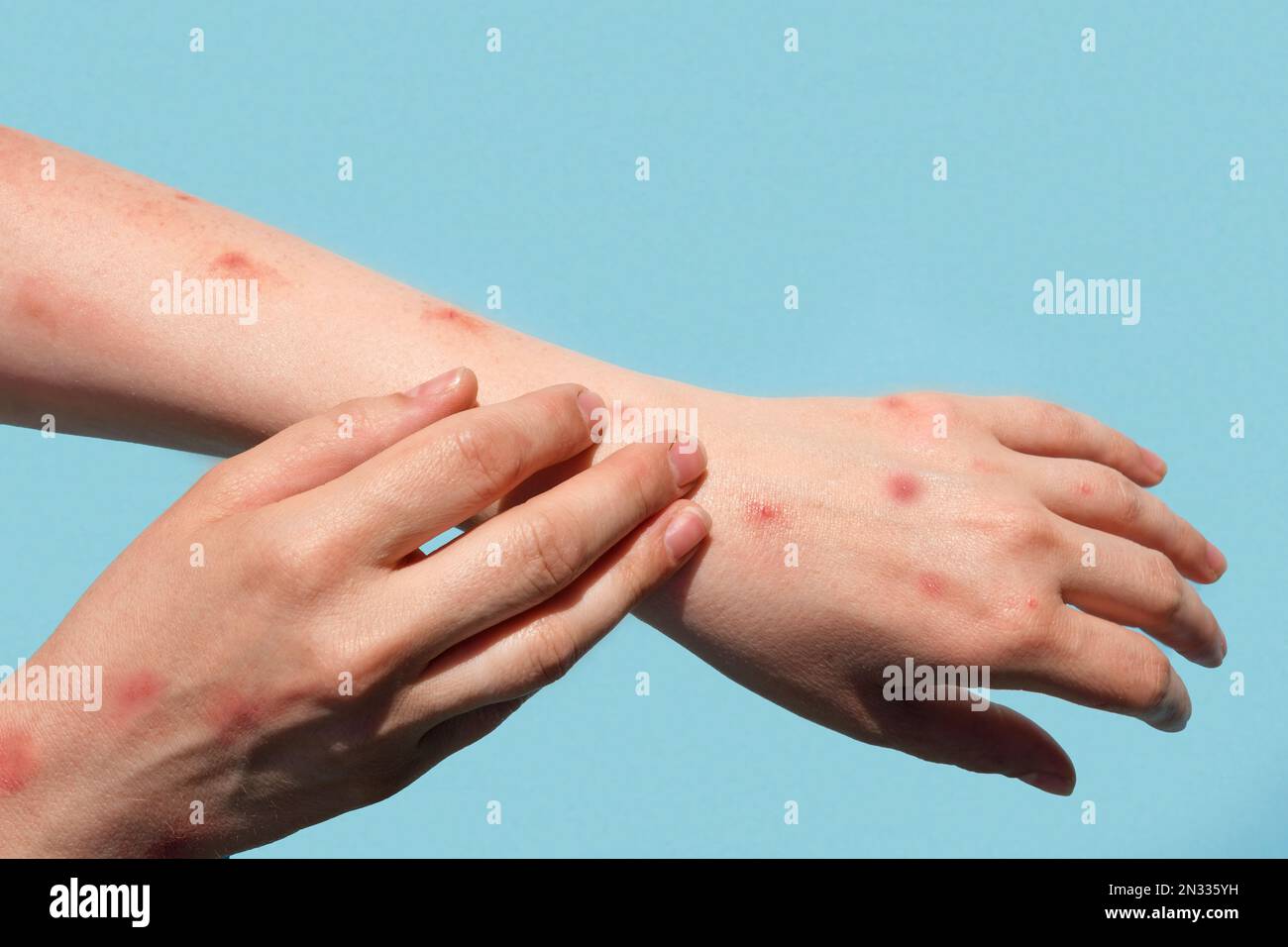 Monkeypox new disease dangerous over the world. Patient with Monkey Pox ...