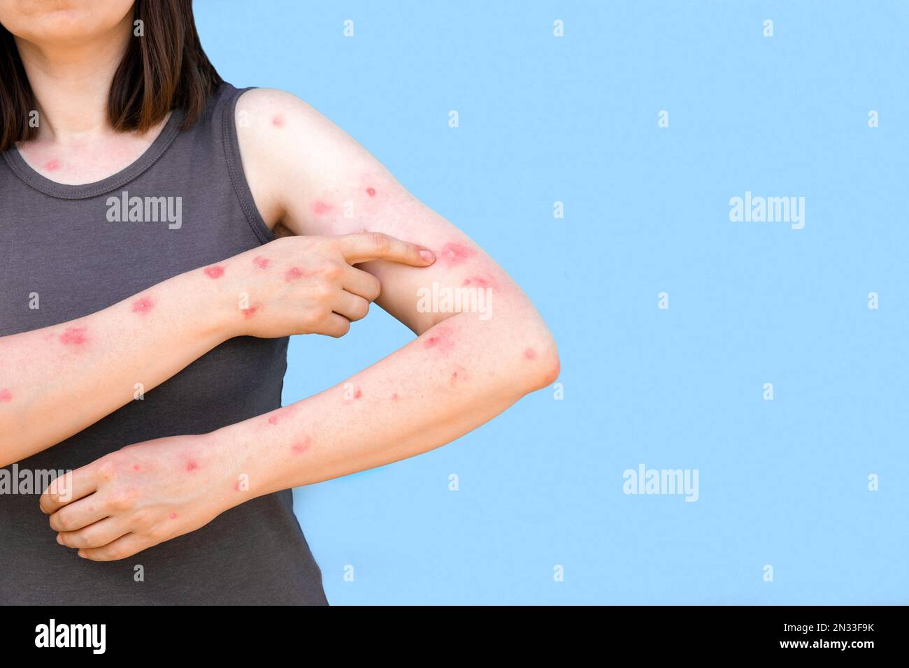 Monkeypox new disease dangerous over the world. Patient with Monkey Pox ...