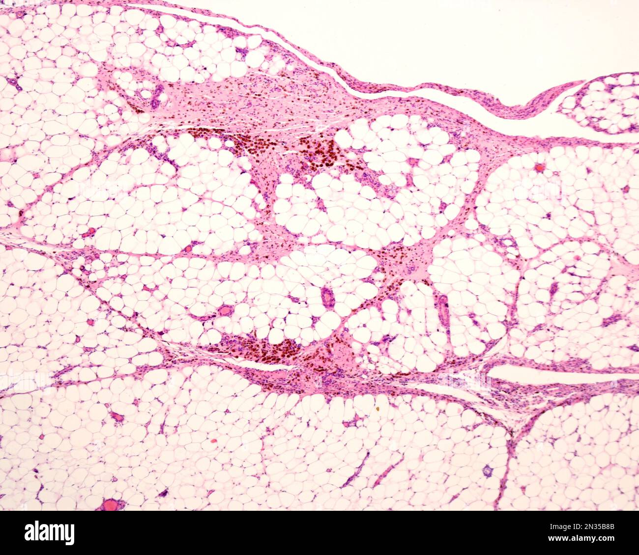 Peritoneal fat showing macrophages marked with colloidal iron ...