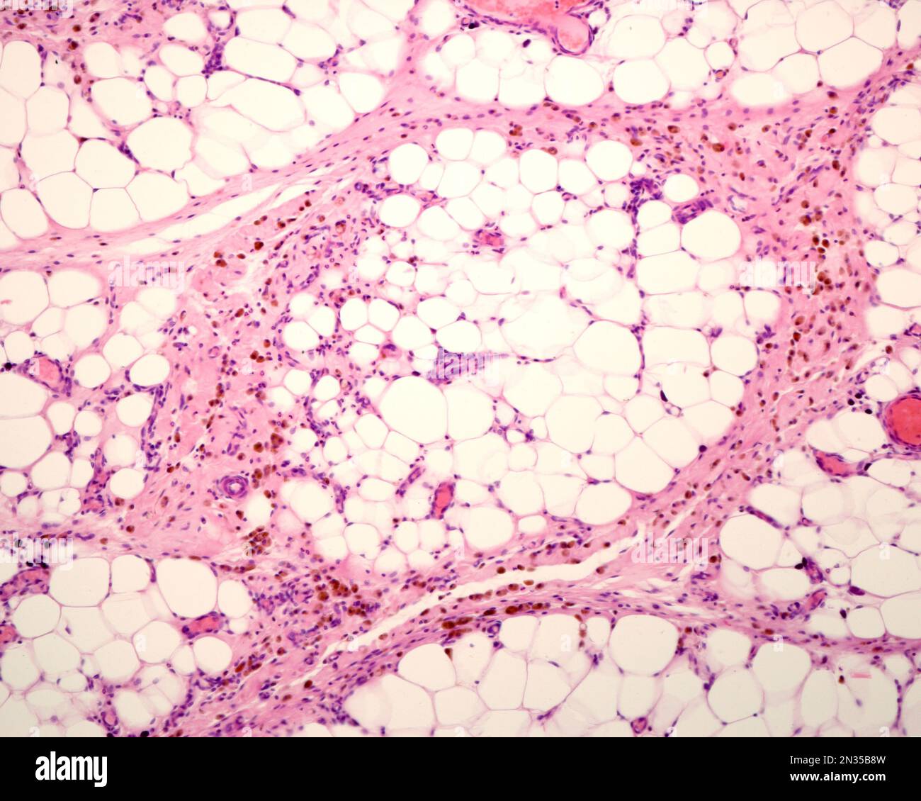 Peritoneal fat showing macrophages marked with colloidal iron ...