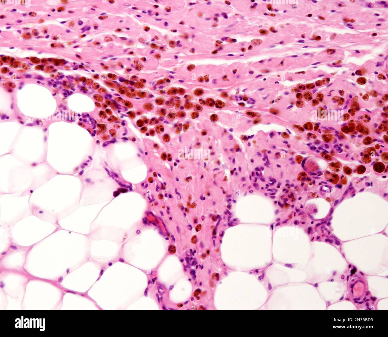 Peritoneal fat showing macrophages marked with colloidal iron ...