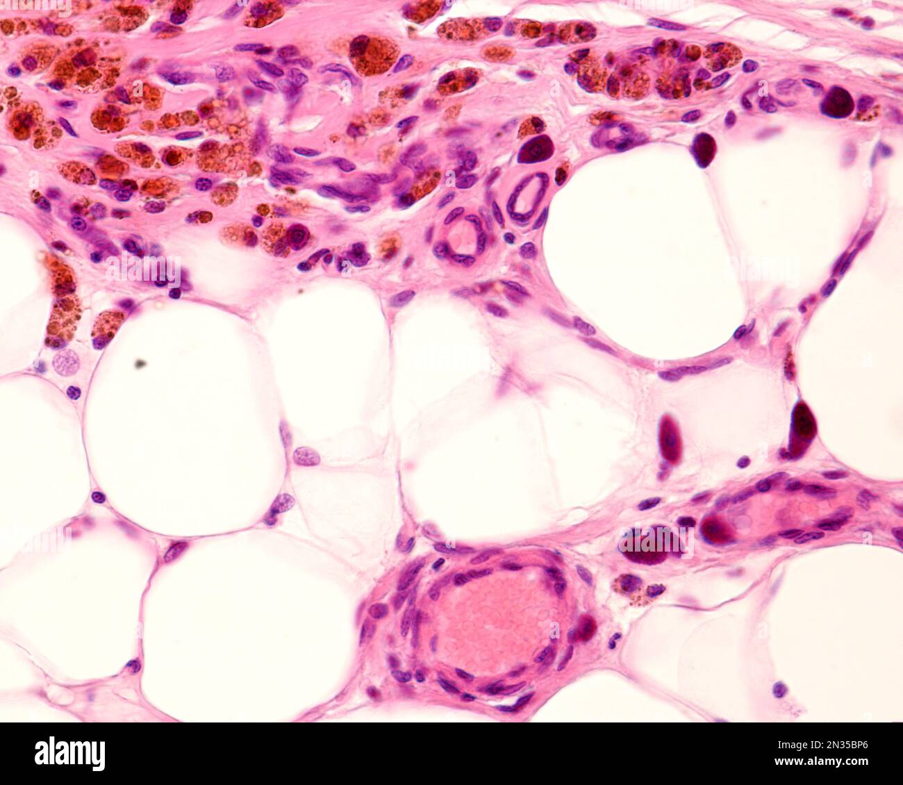Peritoneal fat showing macrophages marked with colloidal iron ...