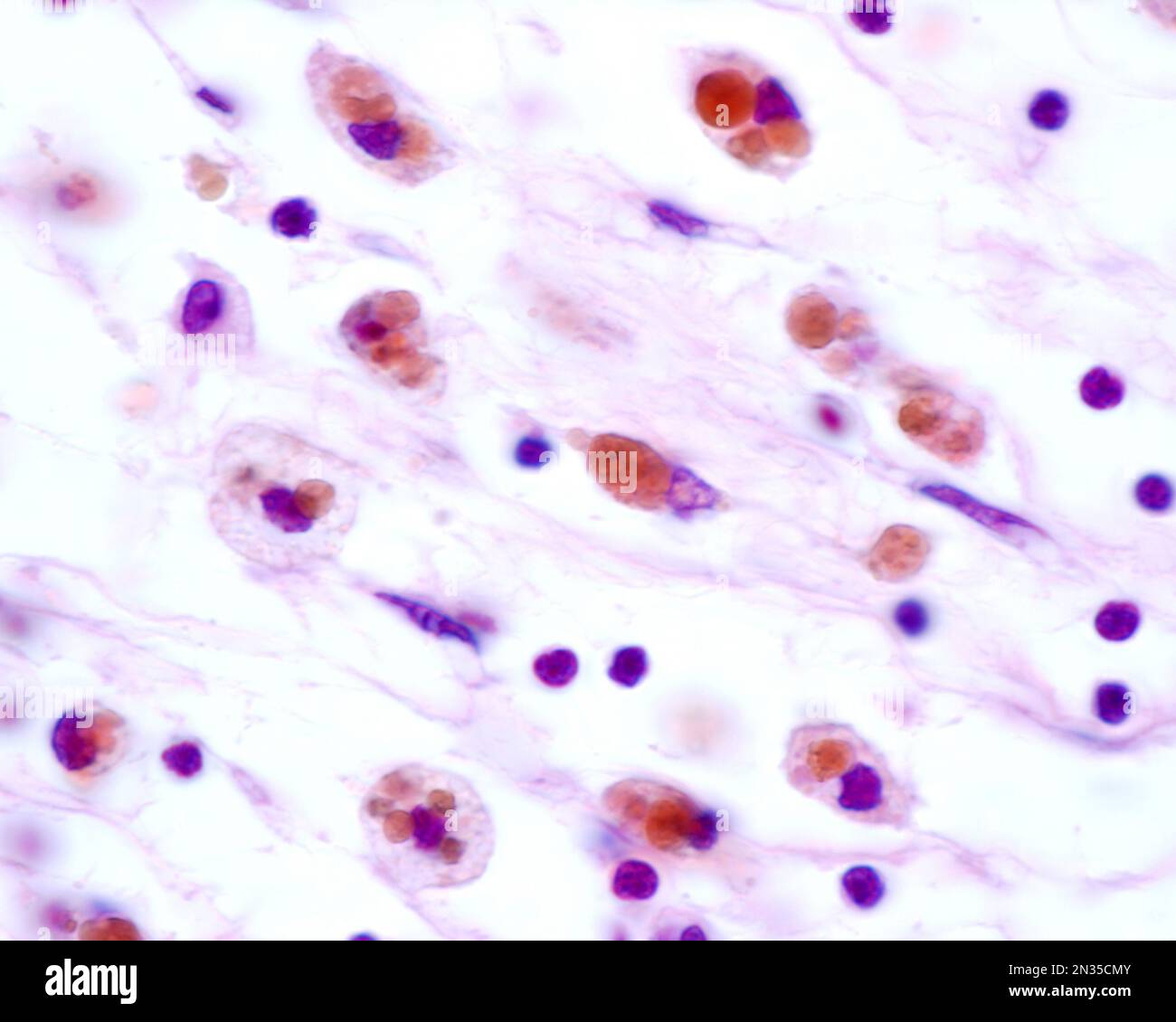 Macrophages showing large brown inclusions originated by phagocytosis ...