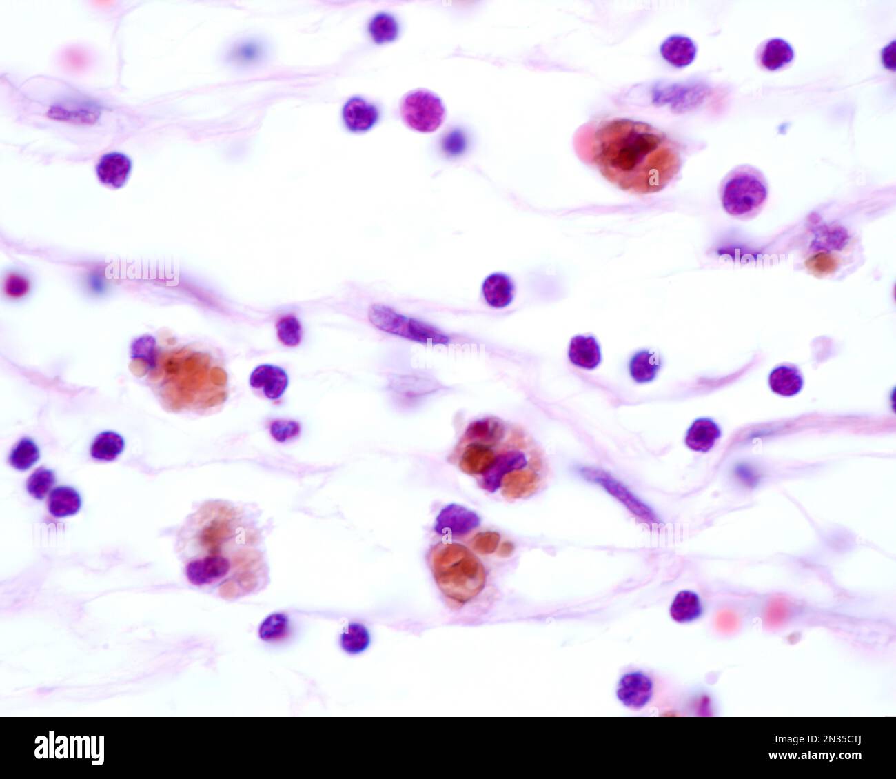 Macrophages showing large brown inclusions originated by phagocytosis ...