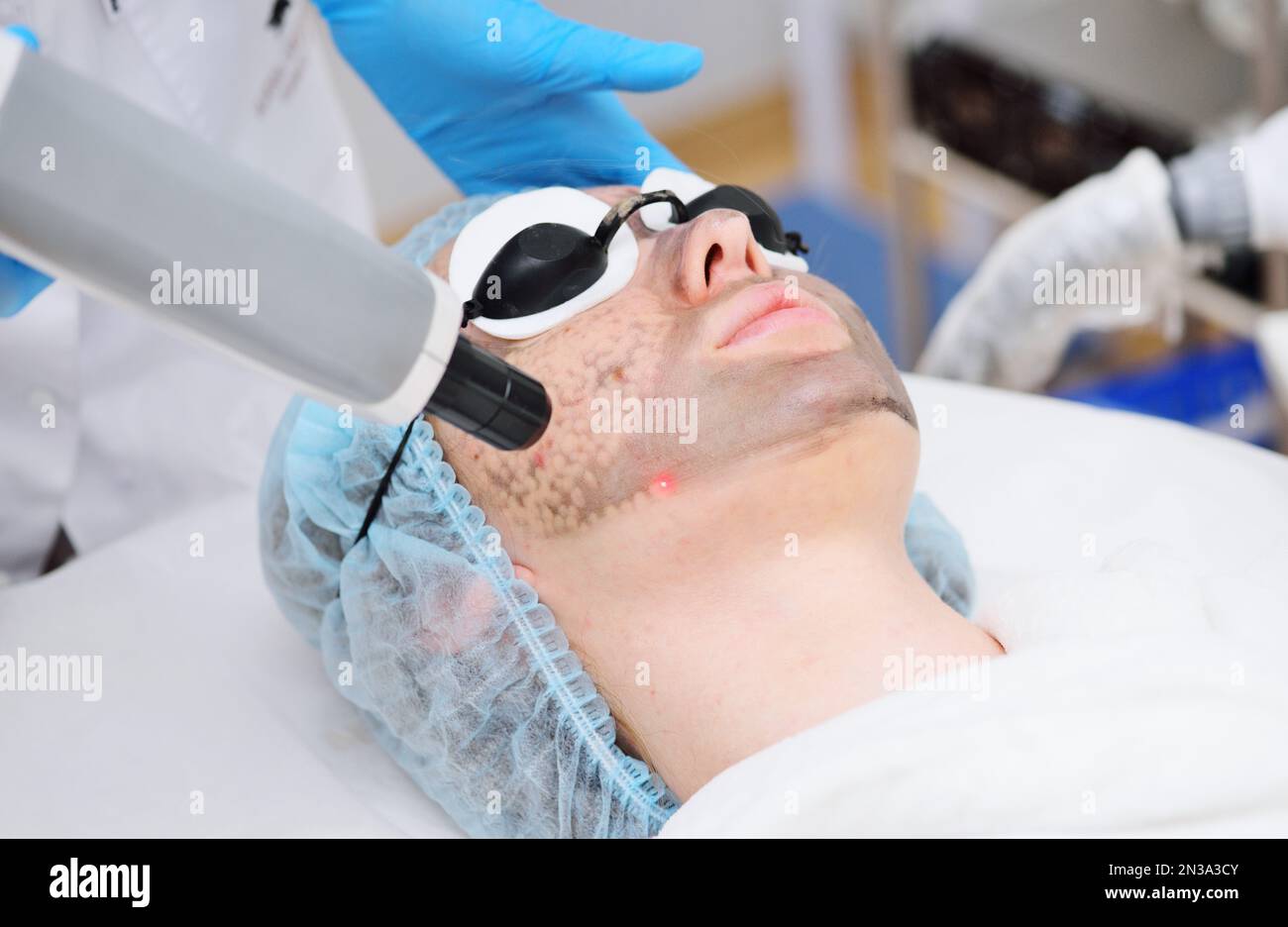 Carbon facial peeling. The cosmetologist cleanses the patient's skin ...