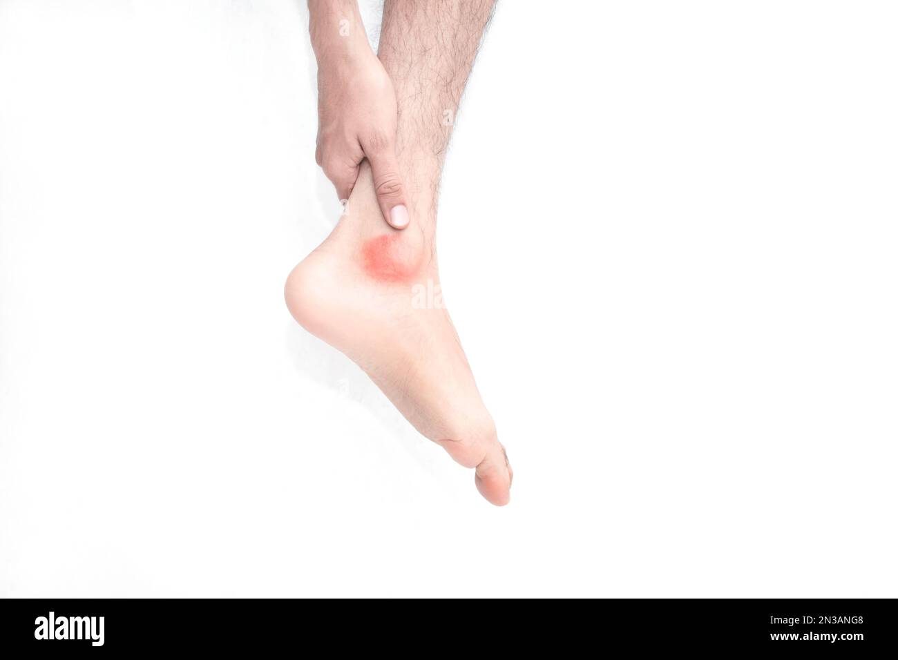A hand holding a leg with a burning red sore ankle on a white ...