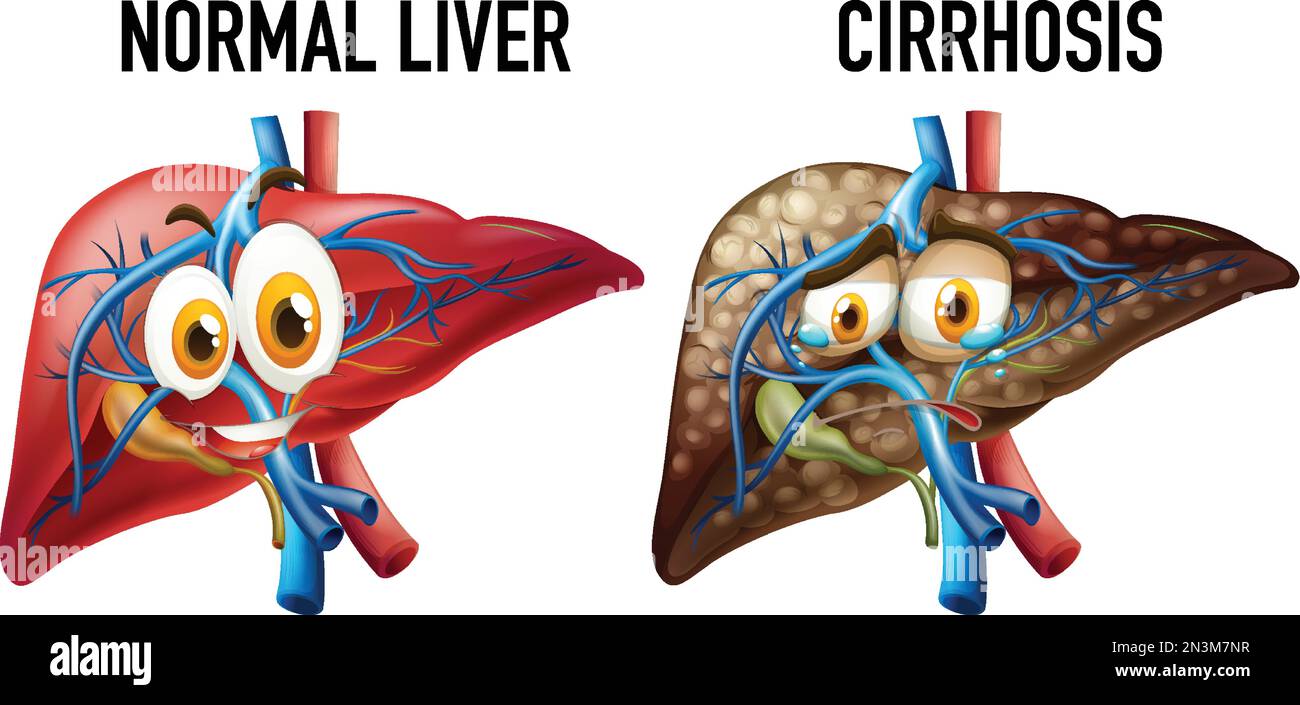 Normal liver and cirrhosis illustration Stock Vector Image & Art - Alamy