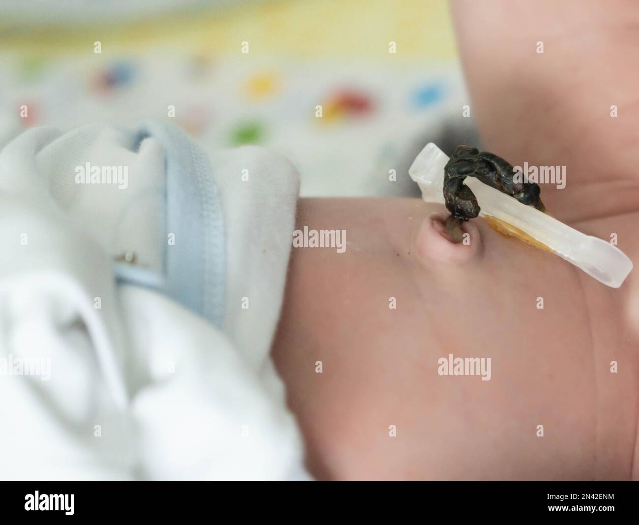 Antibiotic For Umbilical Cord Infection at Ricky Lanctot blog