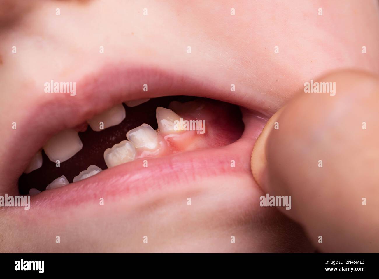 Red swelling on the gums of a child in the oral cavity. Fistula-bump ...