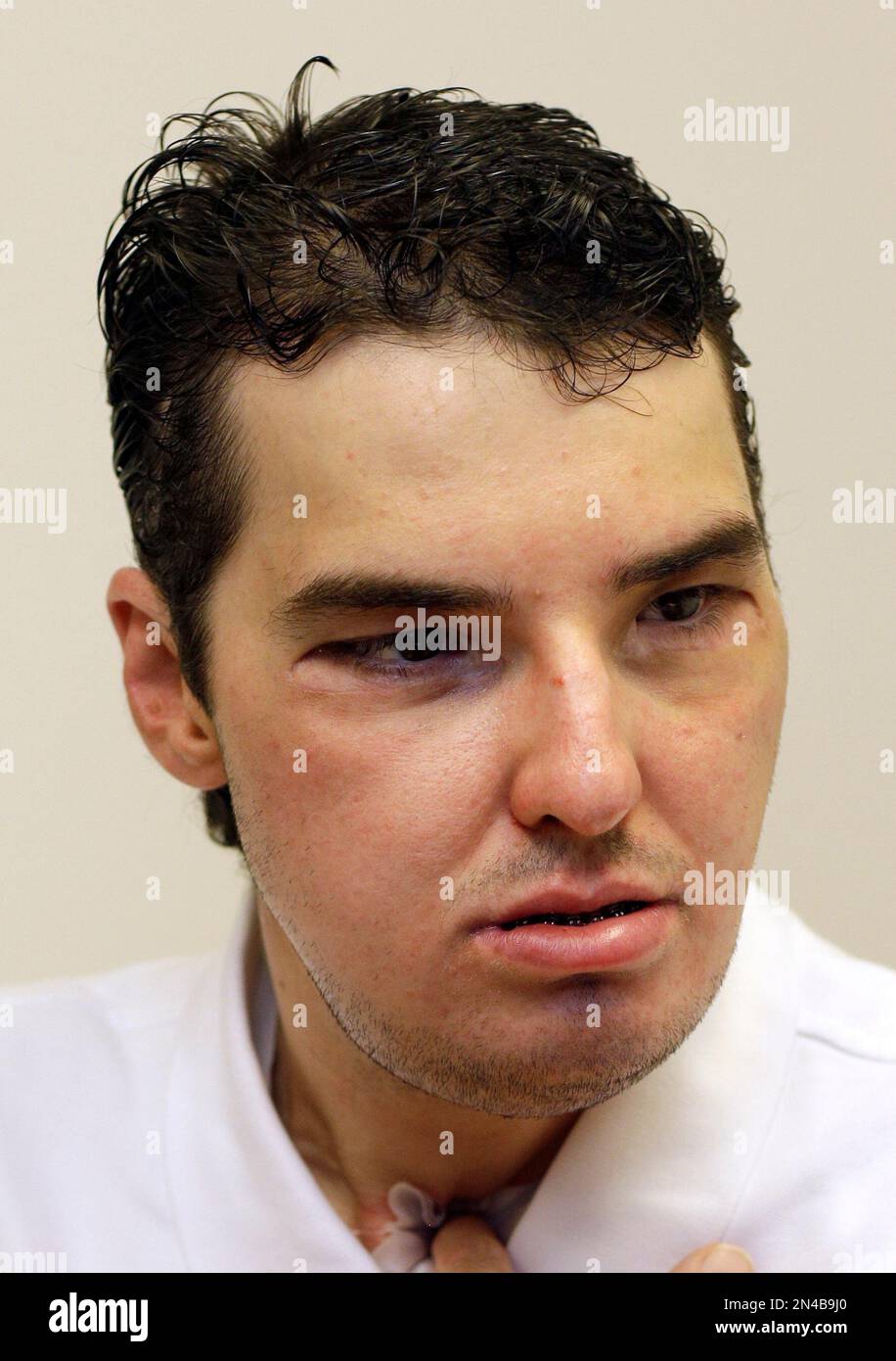 Face transplant recipient Richard Norris shown on June 18, 2013 in Baltimore, USA. (AP Photo ...