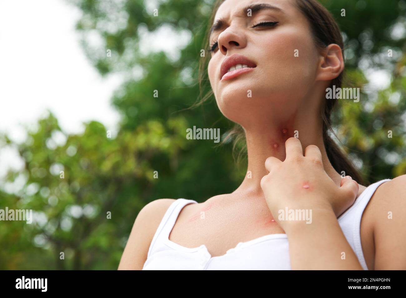 Woman scratching neck with insect bite in park Stock Photo - Alamy