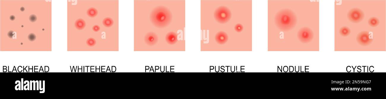 Stages of development of acne. Inflamed skin with scars, acne and ...