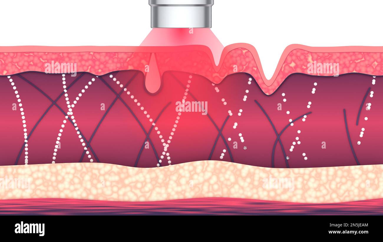 Laser treatment for wrinkles and acne. Skin rejuvenation spa procedure ...