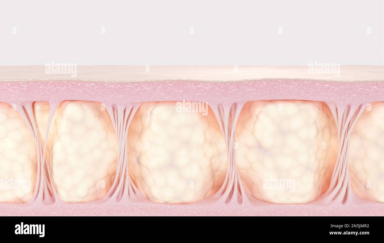 Cellulite skin cross-section after treatment. Adipose cells and ...