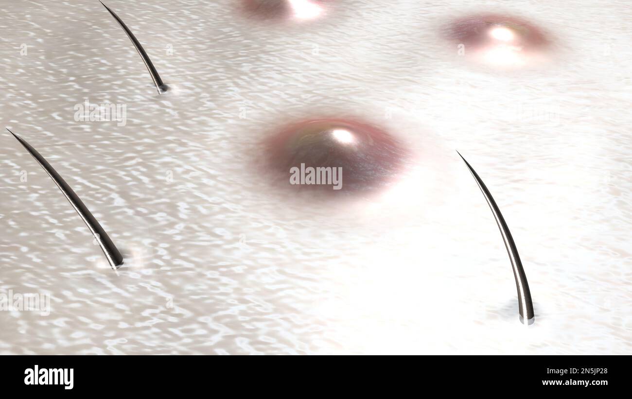 Ingrown hairs and follicle inflammation. Problem skin realistic medical ...