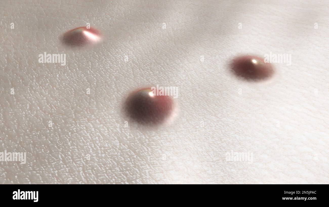 Skin with acne. Medical 3d rendered illustration Stock Photo - Alamy