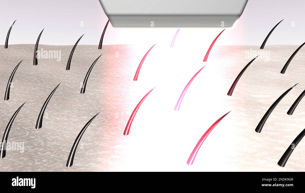 Laser hair removal 3d rendered illustration Stock Photo - Alamy