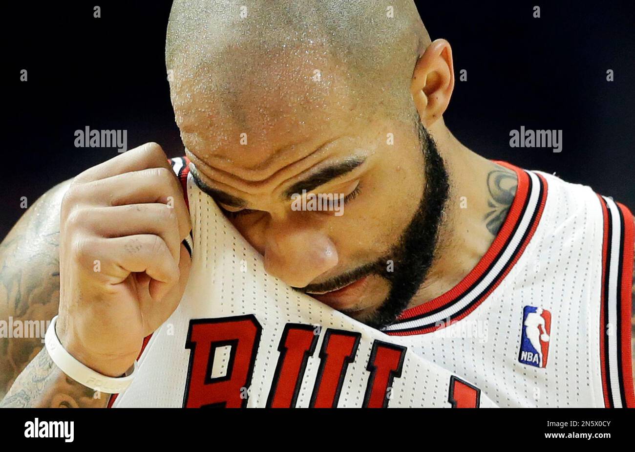 Carlos Boozer Hair Transplant