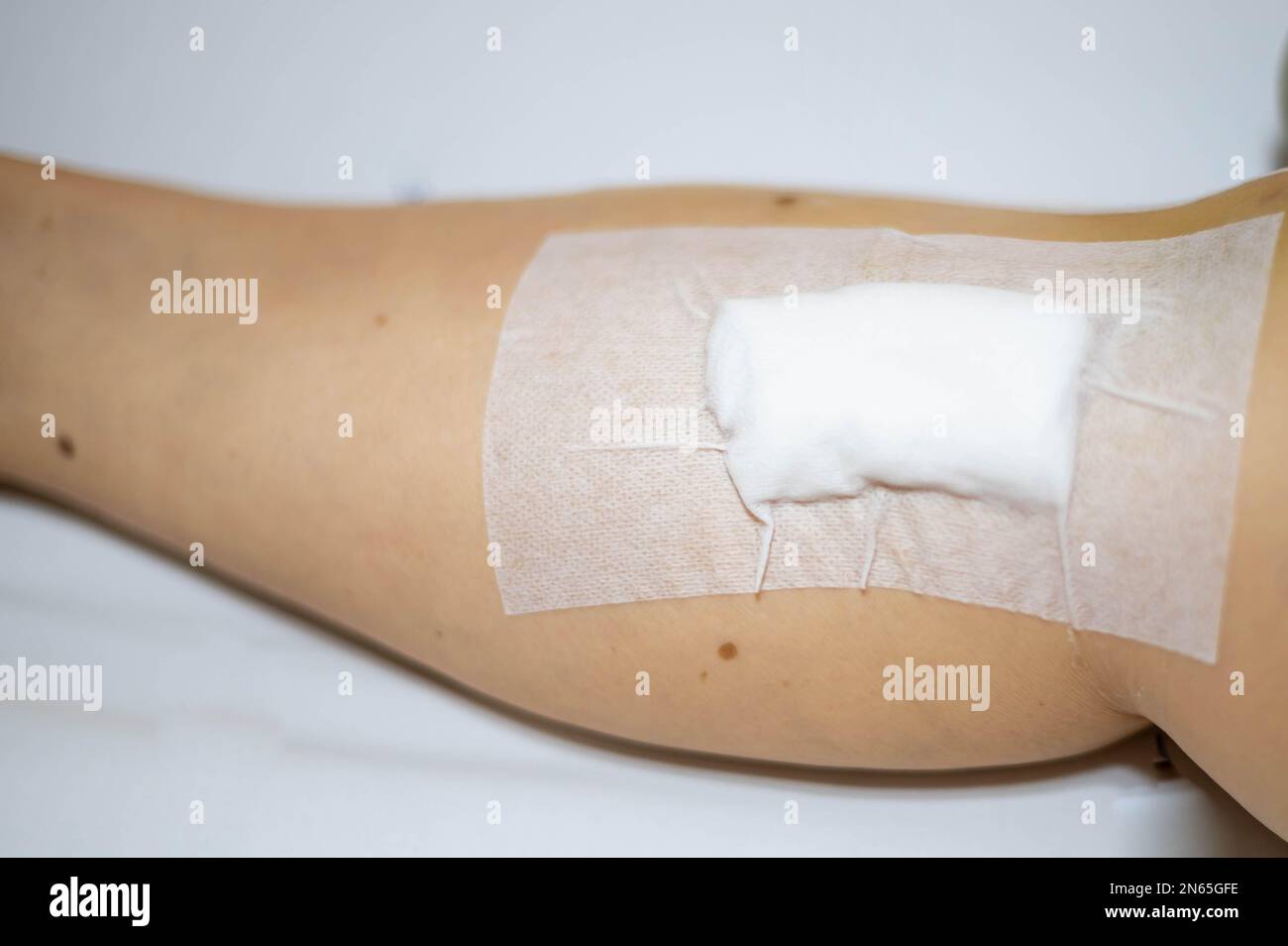 The old lady woman patient shows her scars from surgical wound surgery ...