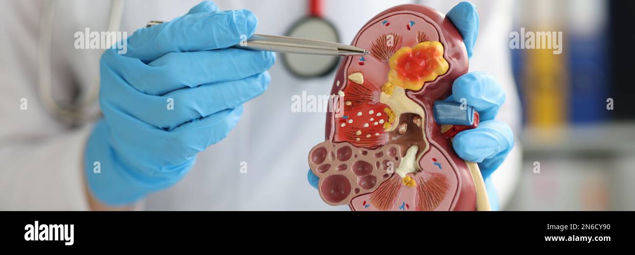 Urology and treatment of kidney diseases closeup Stock Photo - Alamy