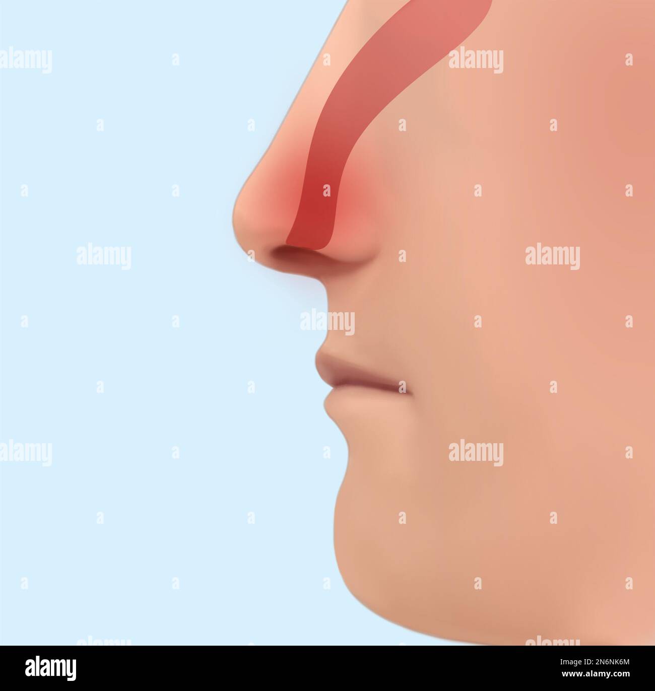 Nasal spray advertisement poster. Illustration of person, focus on nose ...