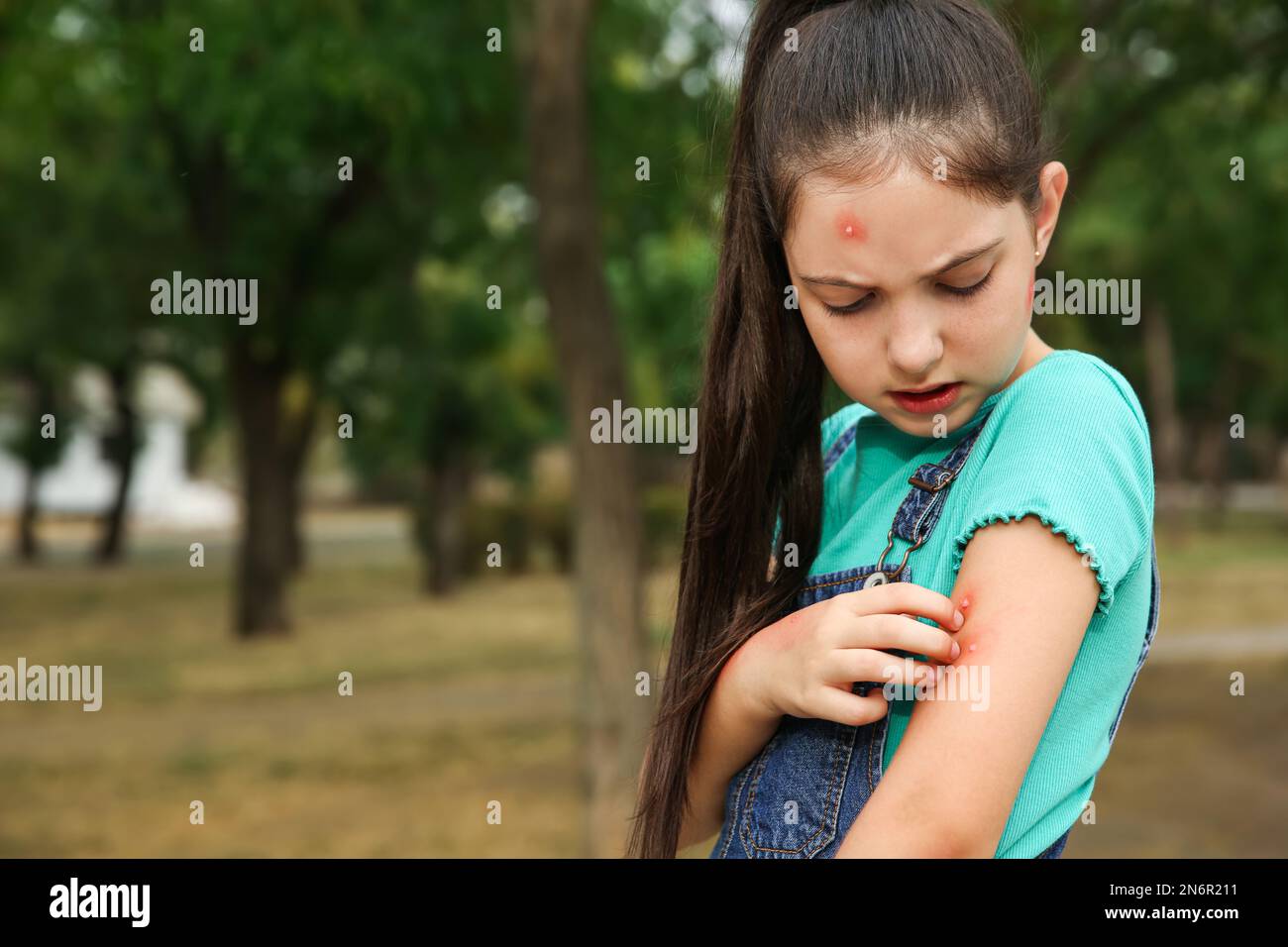 Girl scratching arm with insect bites in park. Space for text Stock ...