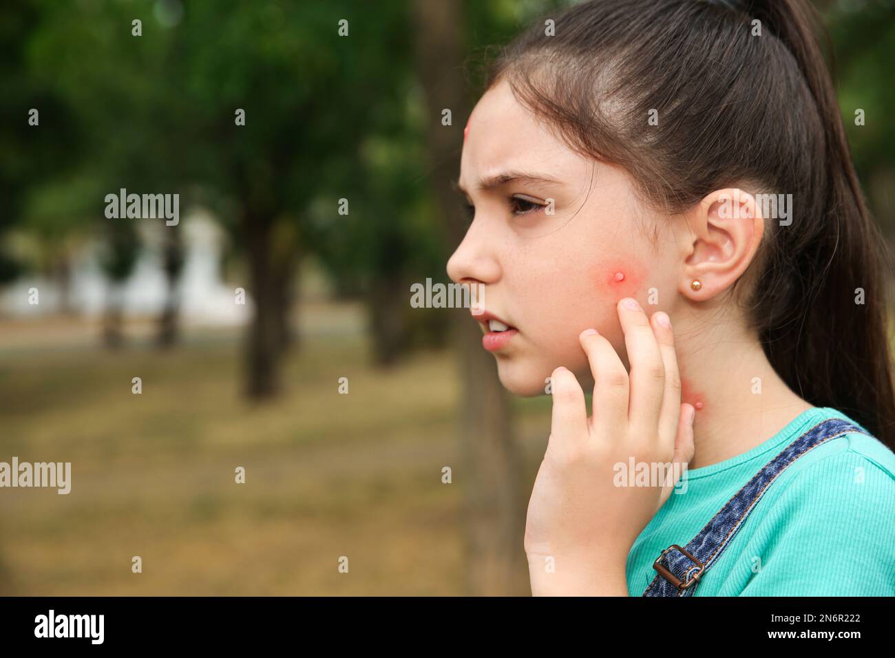 Girl touching cheek with insect bite in park. Space for text Stock ...