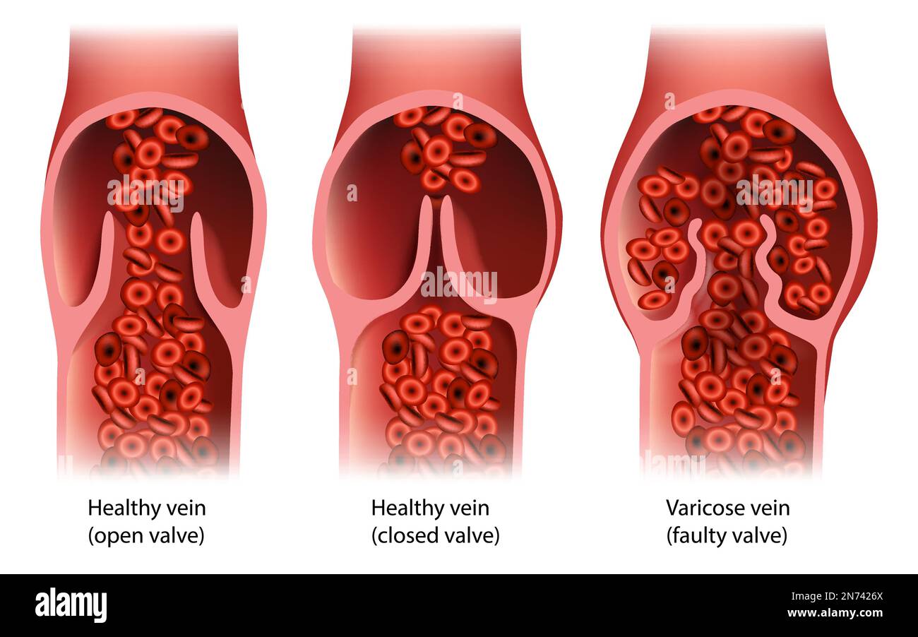 Chronic Venous Insufficiency or venous reflux.Venous Disease Varicose ...
