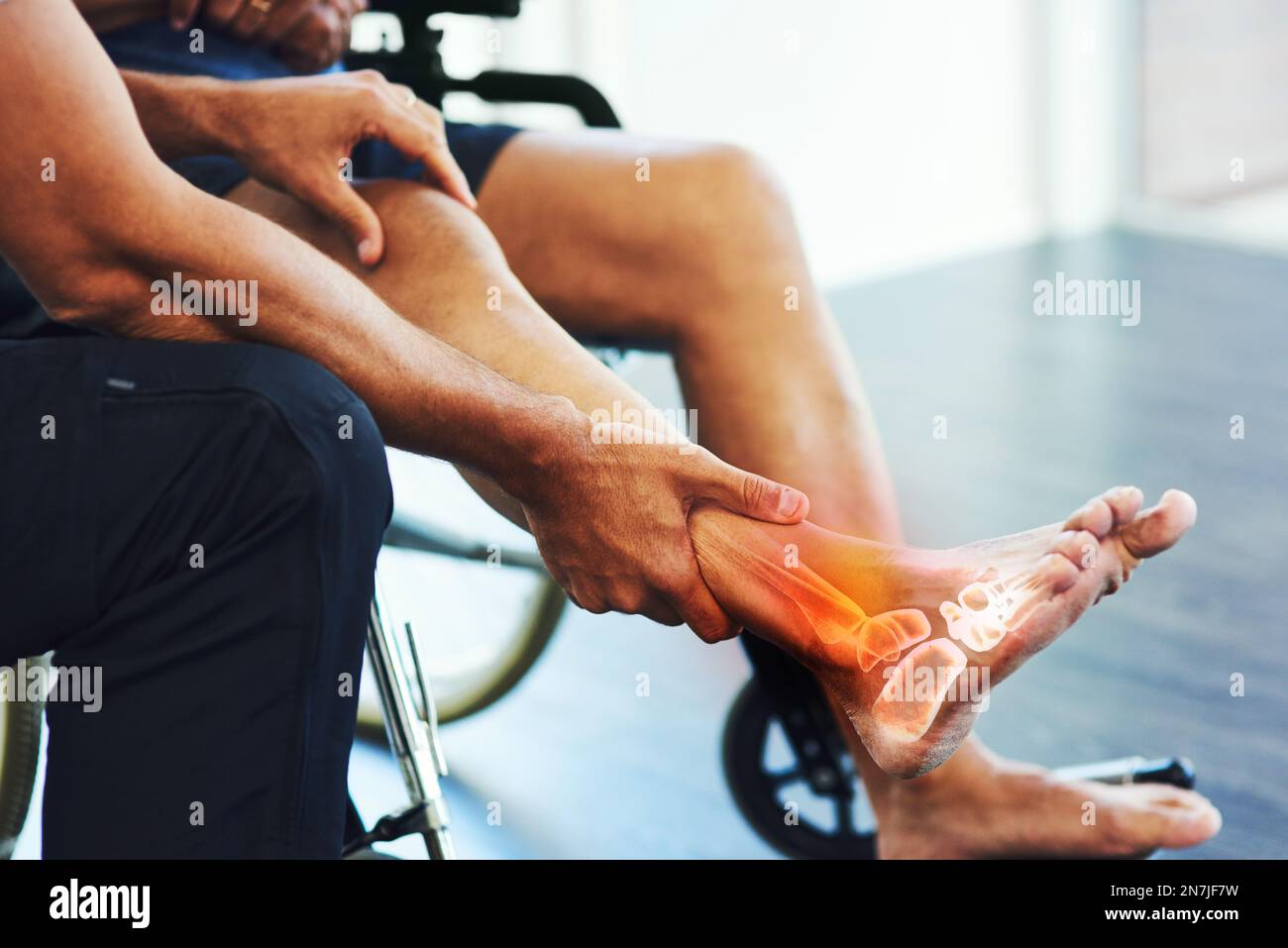 Rehabilitation, physiotherapist and help a patient with foot injury ...