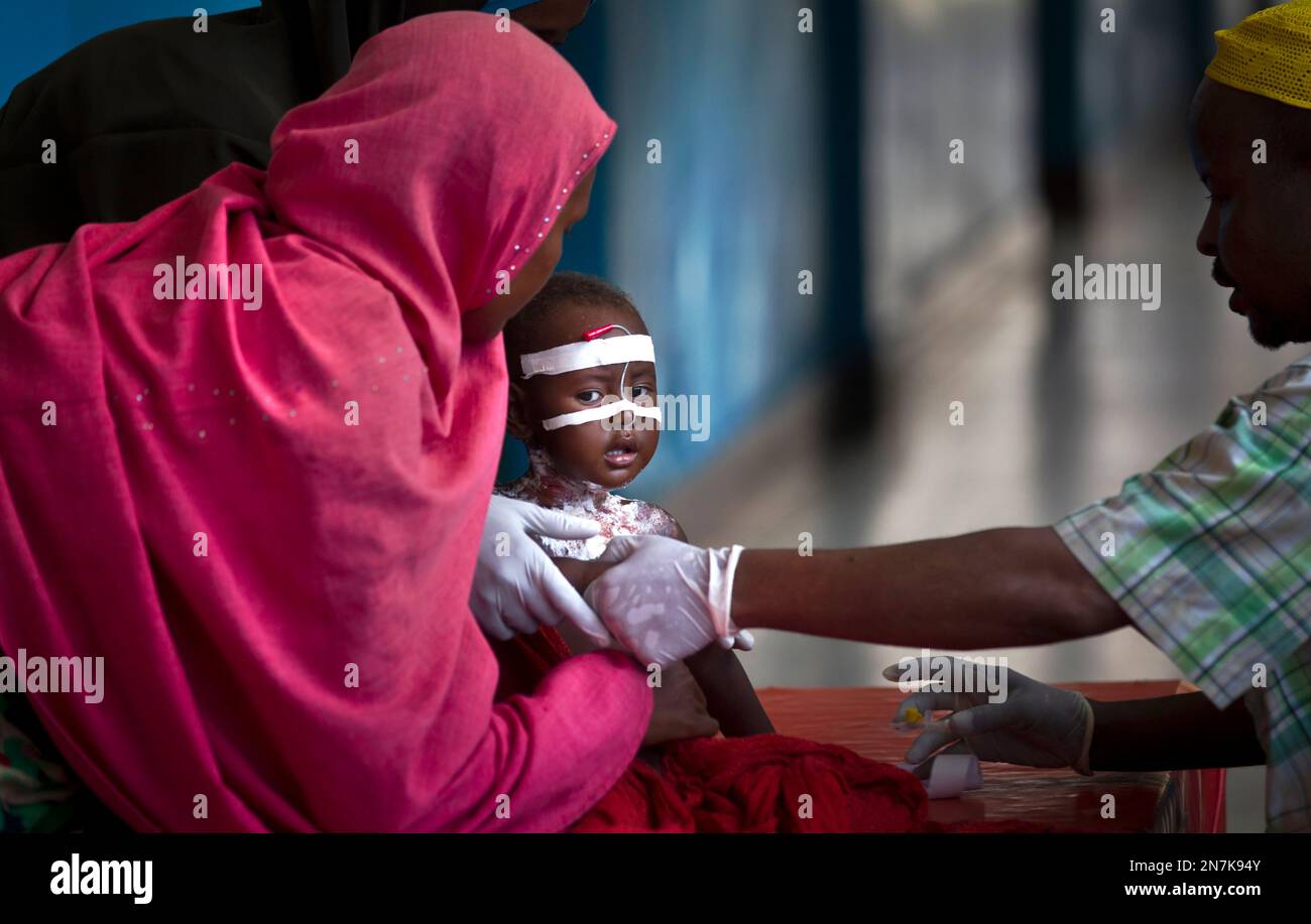 A Somali child with malnutrition is treated in the Benadir hospital in ...