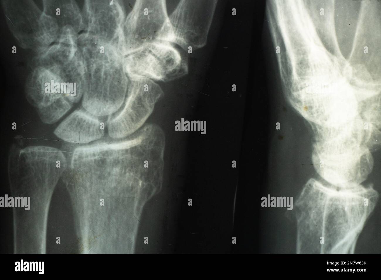 X-ray of an elderly person with osteoporosis and arthritis arthrosis ...