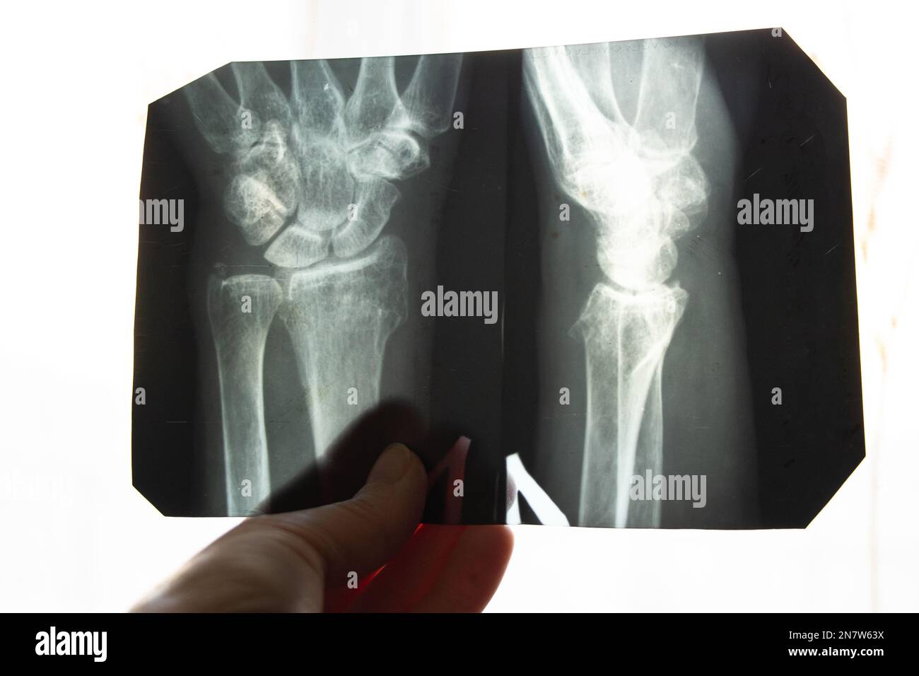 X-ray of an elderly person with osteoporosis and arthritis arthrosis ...