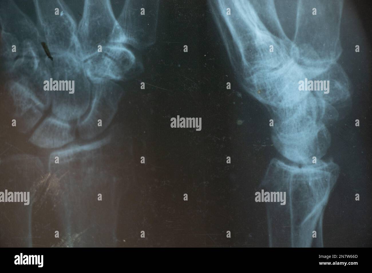 X-ray of an elderly person with osteoporosis and arthritis arthrosis ...