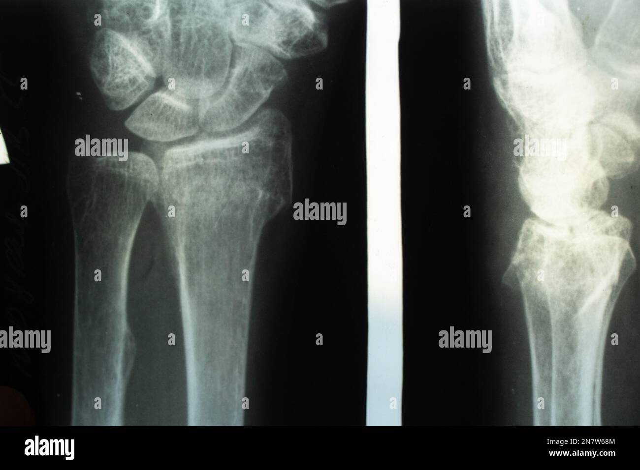 Osteoporotic Bone X Ray