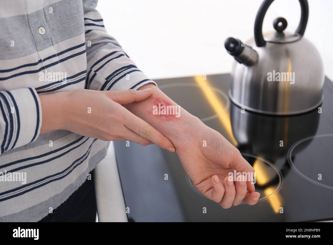 Injury burn stove hi-res stock photography and images - Alamy