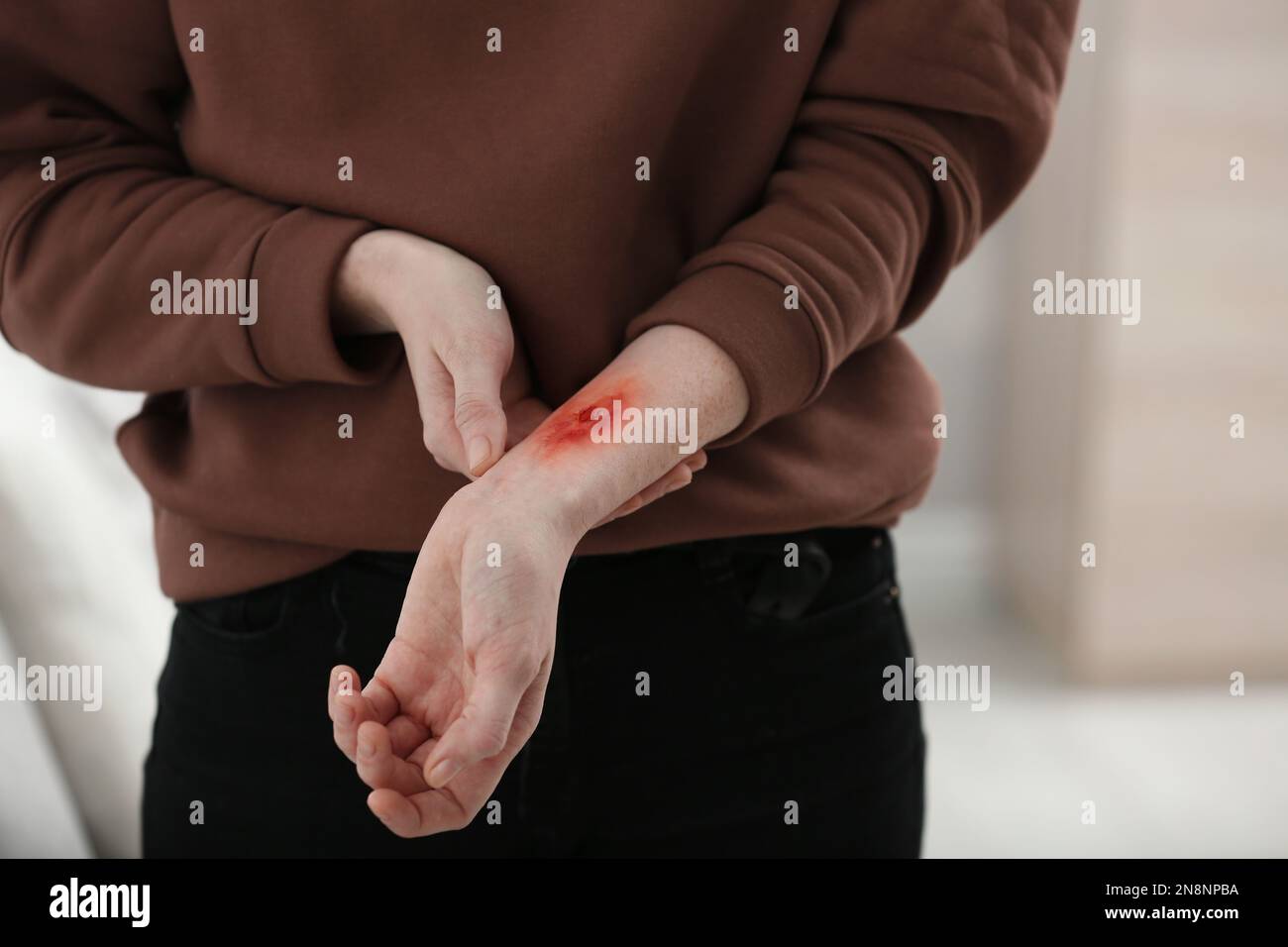 Burn injury girl hi-res stock photography and images - Alamy