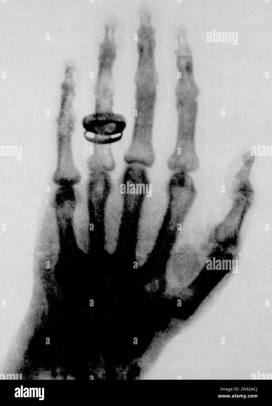 This is one of the earliest known X-rays taken by inventor Wilhelm ...