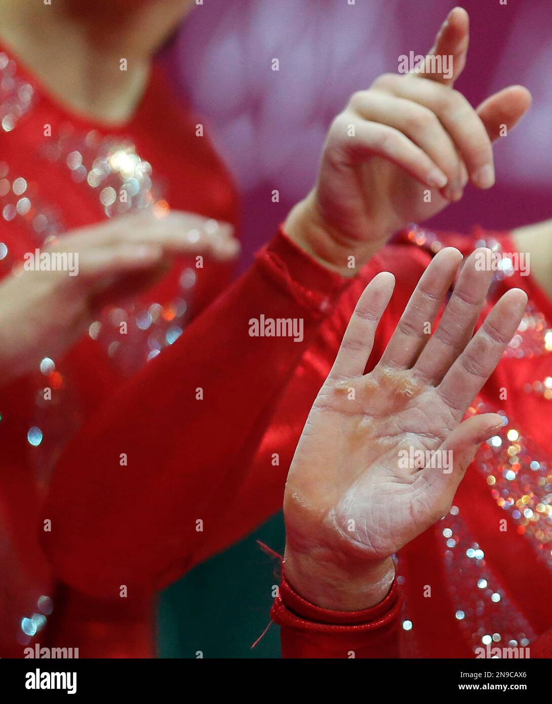 The hand of gymnast Elizabeth Tweddle from Great Britain show calluses ...
