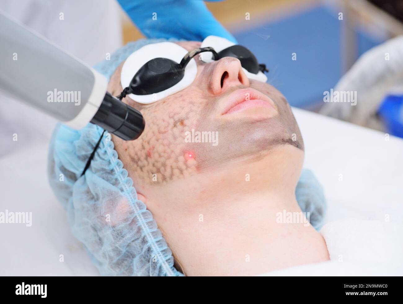 Carbon facial peeling. The cosmetologist cleanses the patient's skin ...