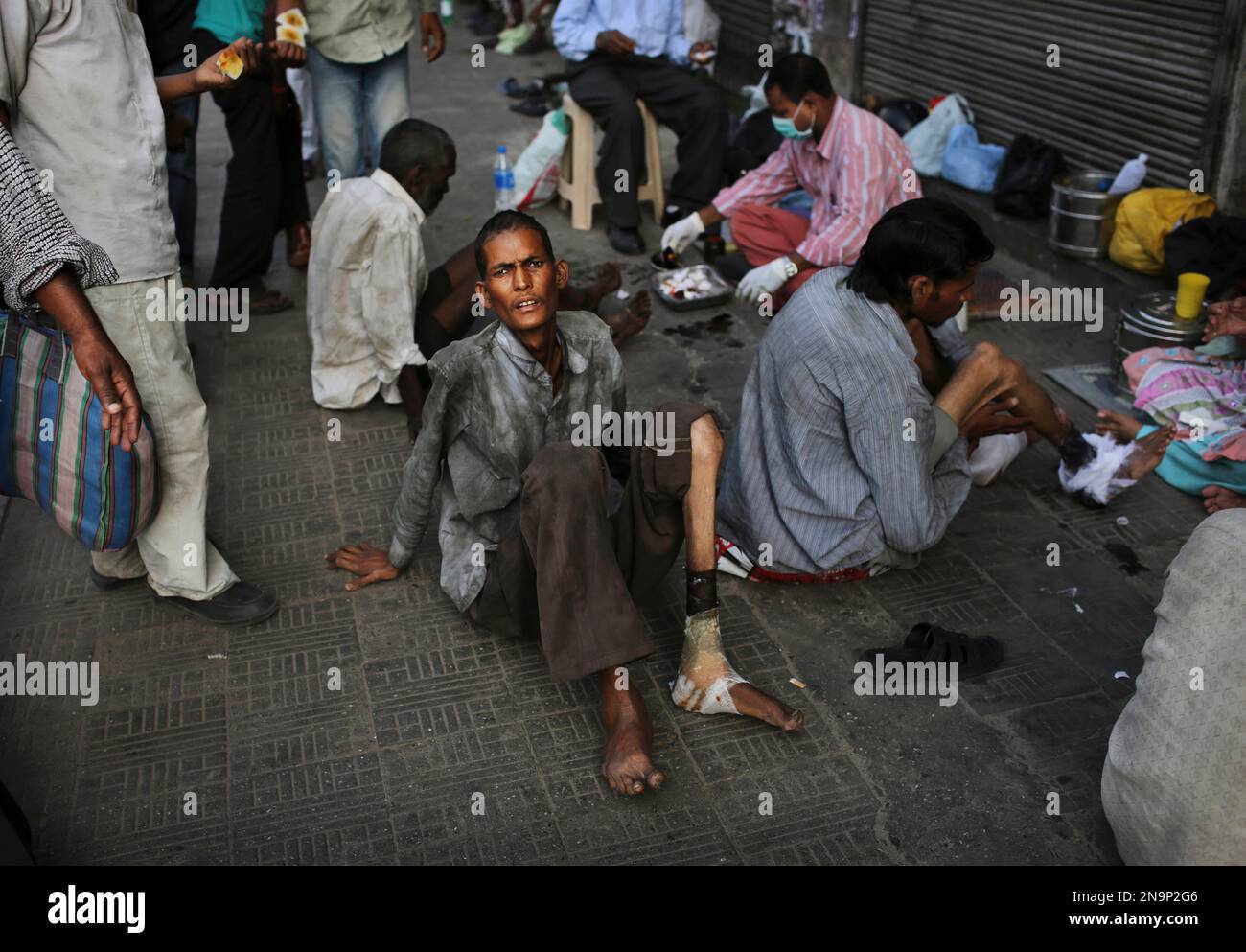 A homeless Indian man suffering from tuberculosis and burns to his foot ...