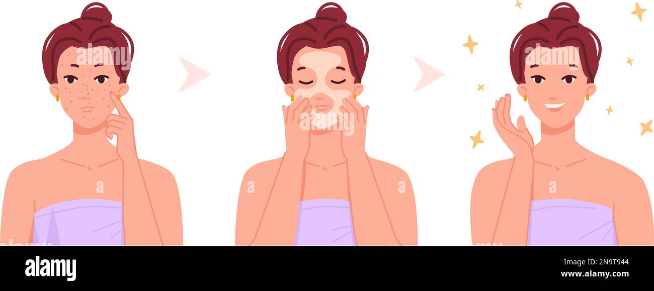 Before after acne. Girls pimples treatment steps, teenager bad skin ...