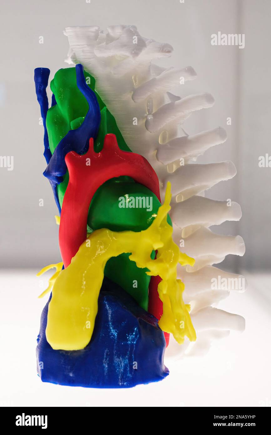Madrid, Spain. 12th Feb, 2023. Leakage of a tumor surgical planning ...