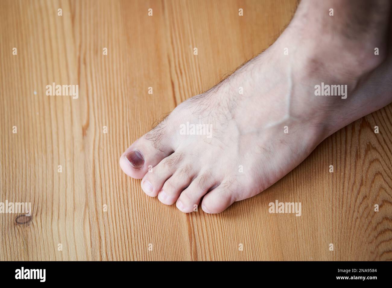 A toe is injured, a heavy object has fallen on the finger. Hematoma ...