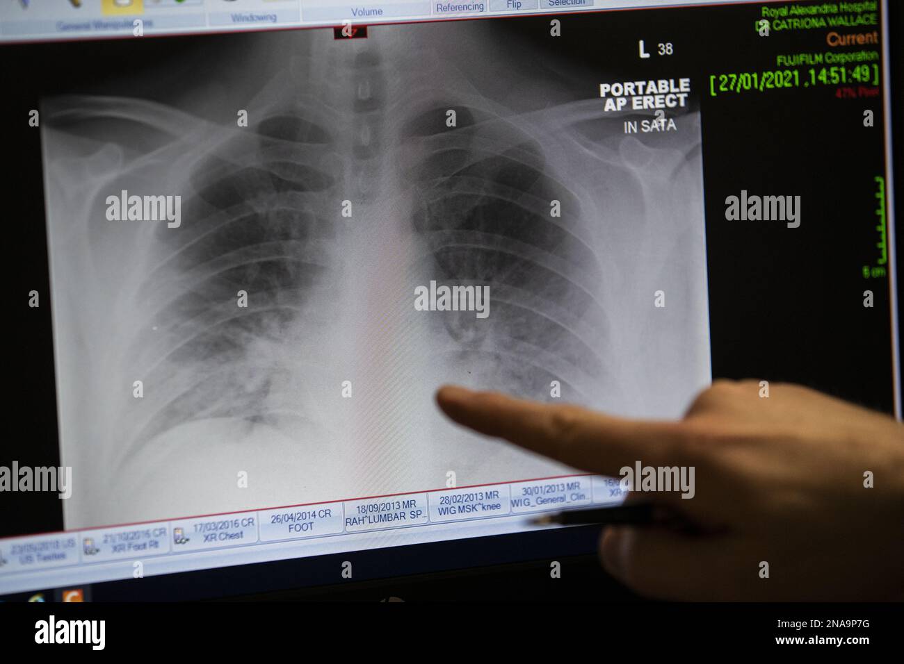 File photo dated 27/01/21 of a doctor analysing the chest scan of a ...