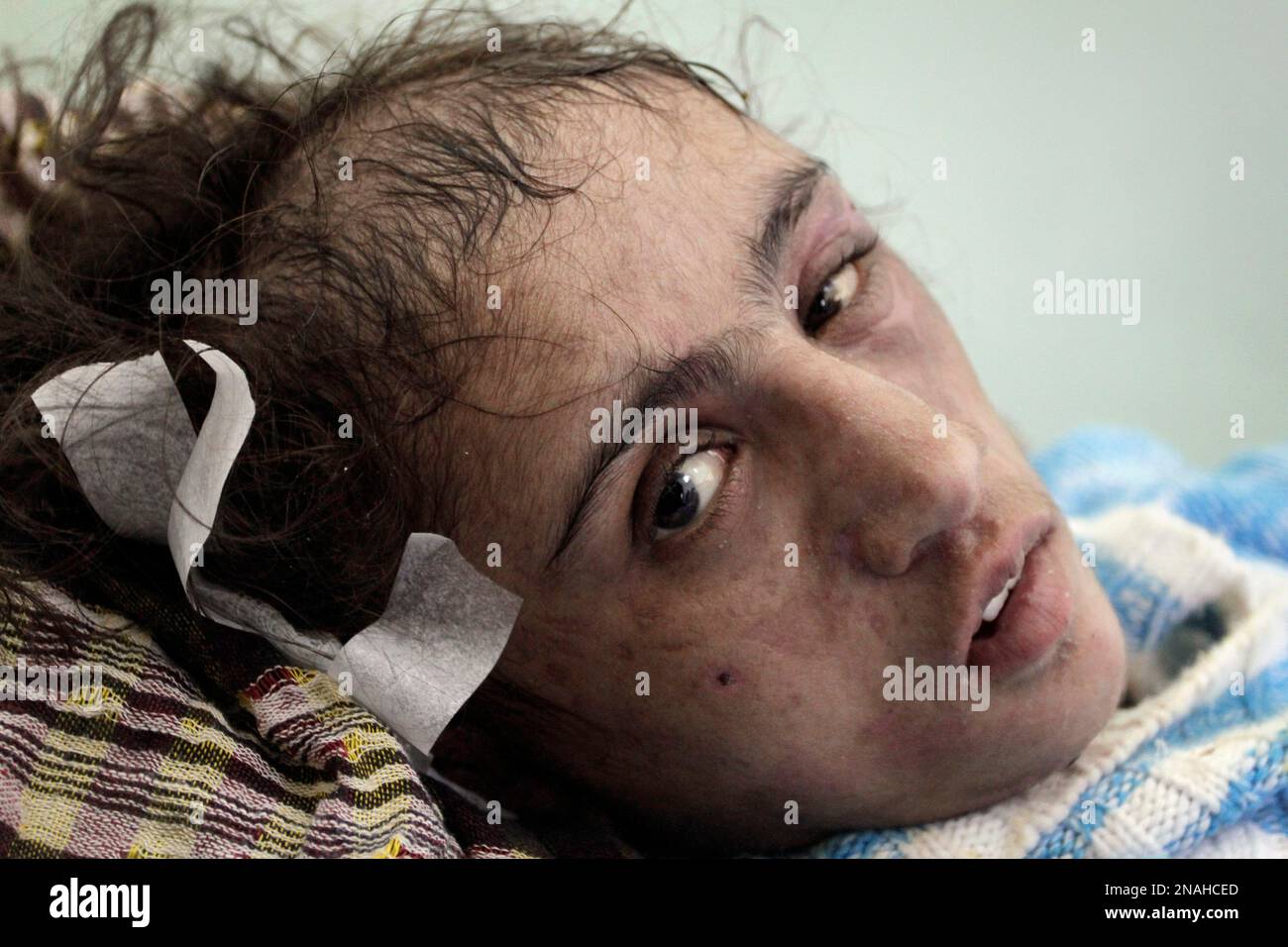 Fifteen year-old Sahar Gul, rests on a bed at a hospital in Kabul ...