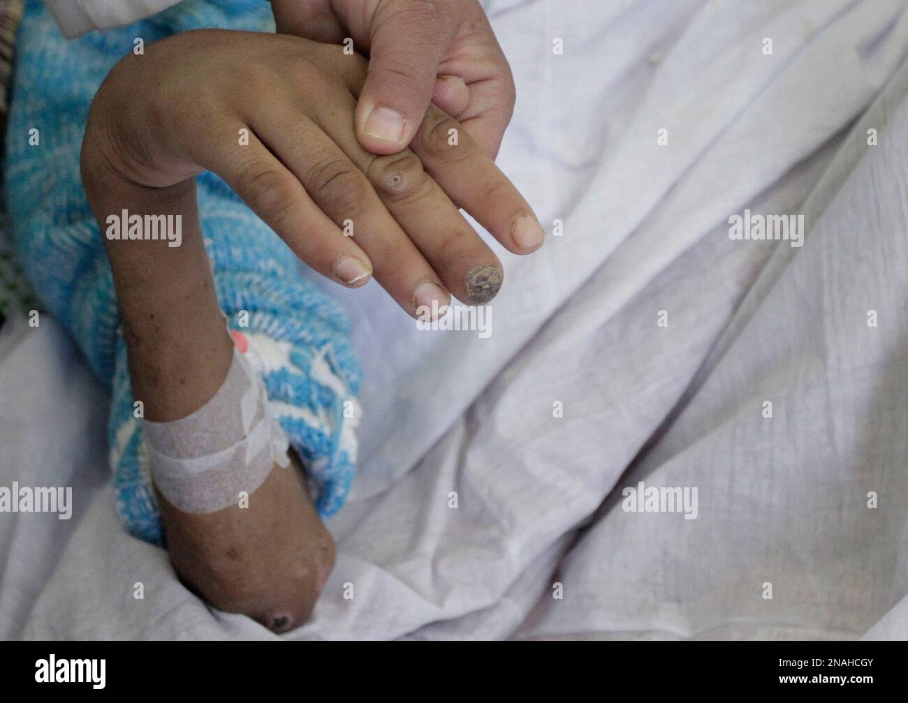 Fifteen year-old Sahar Gul, shows her hand displaying a finger where he ...