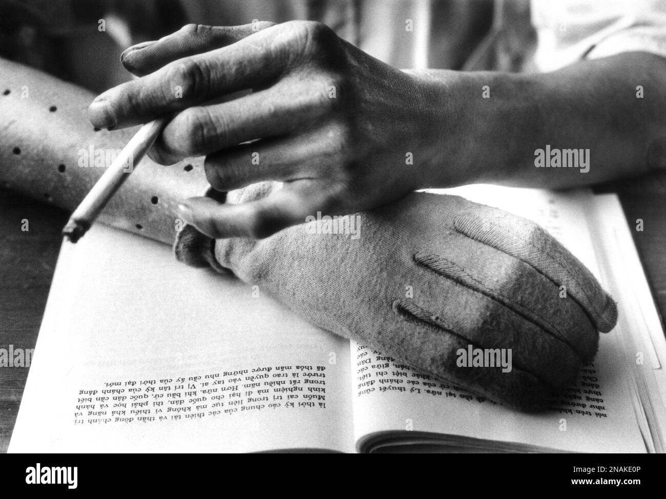 A person with a prosthetic arm in Vietnam. From the Eddie Adams series ...