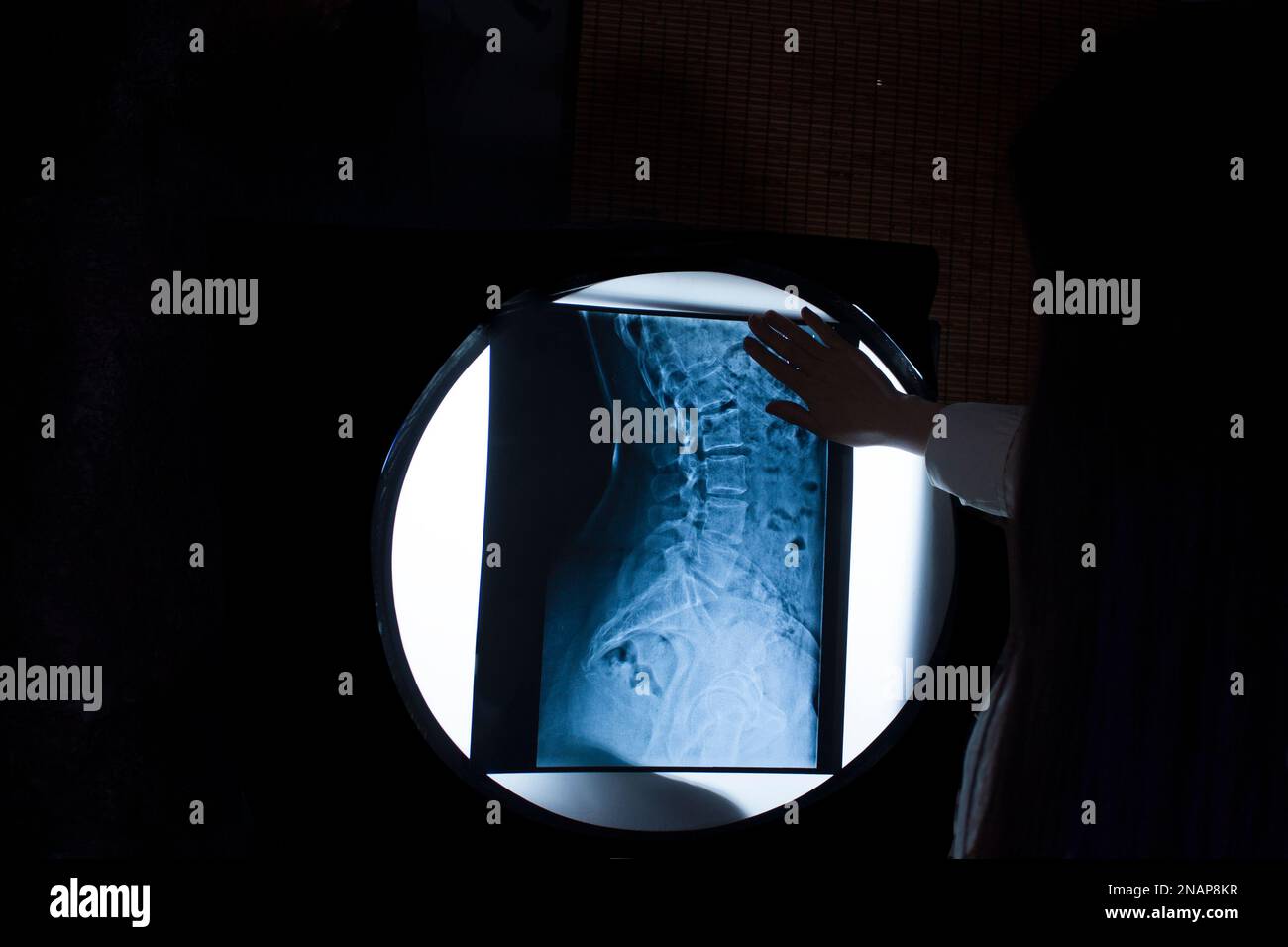 Doctor check scoliosis spine hi-res stock photography and images - Alamy
